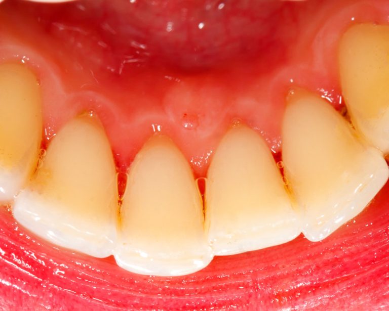 Halitosis - preventing bad breath with some simple habits and tips